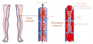 schema-phlebite - Dr Kahina Betroune