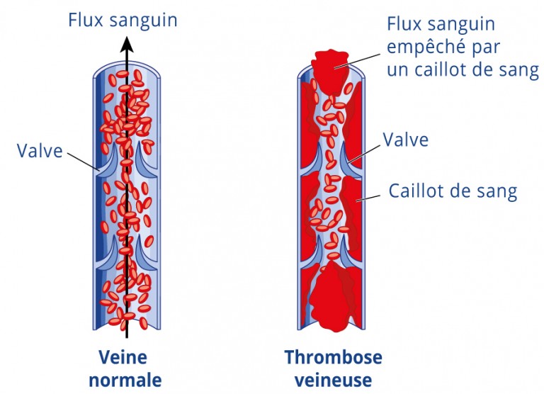 VARICES / PATHOLOGIES DU SYSTEME CIRCULATOIRE - Dr Kahina Betroune