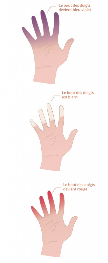 Phénomène de raynaud (syndrome de raynaud et maladie de raynaud)